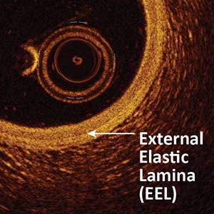 Stent Diameter Sizing - Cardiology Apps